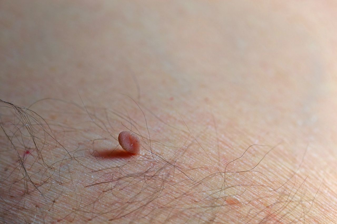 Skin Tags - Paradise Valley Dermatology