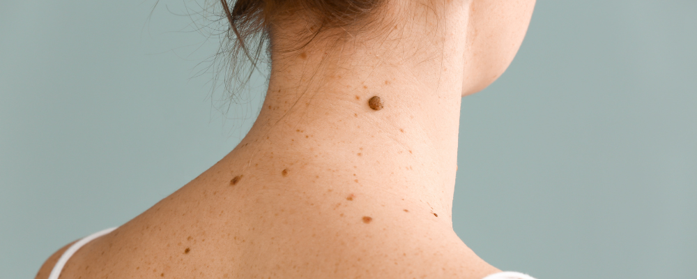 Skin Cancer Basics: Know Your ABCDEs - Paradise Valley Dermatology